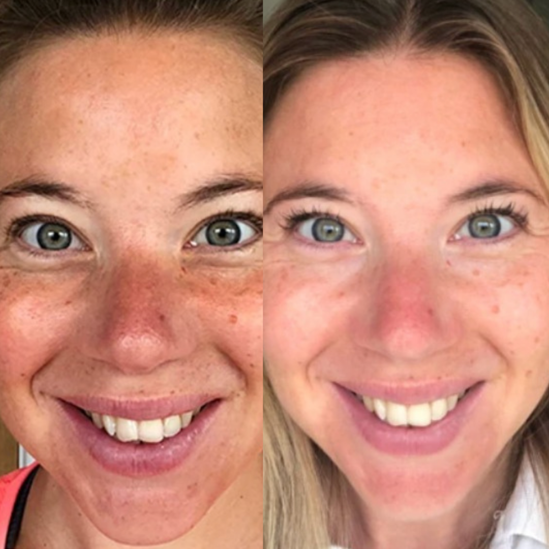 Jacqui's Story - Kollo Health US